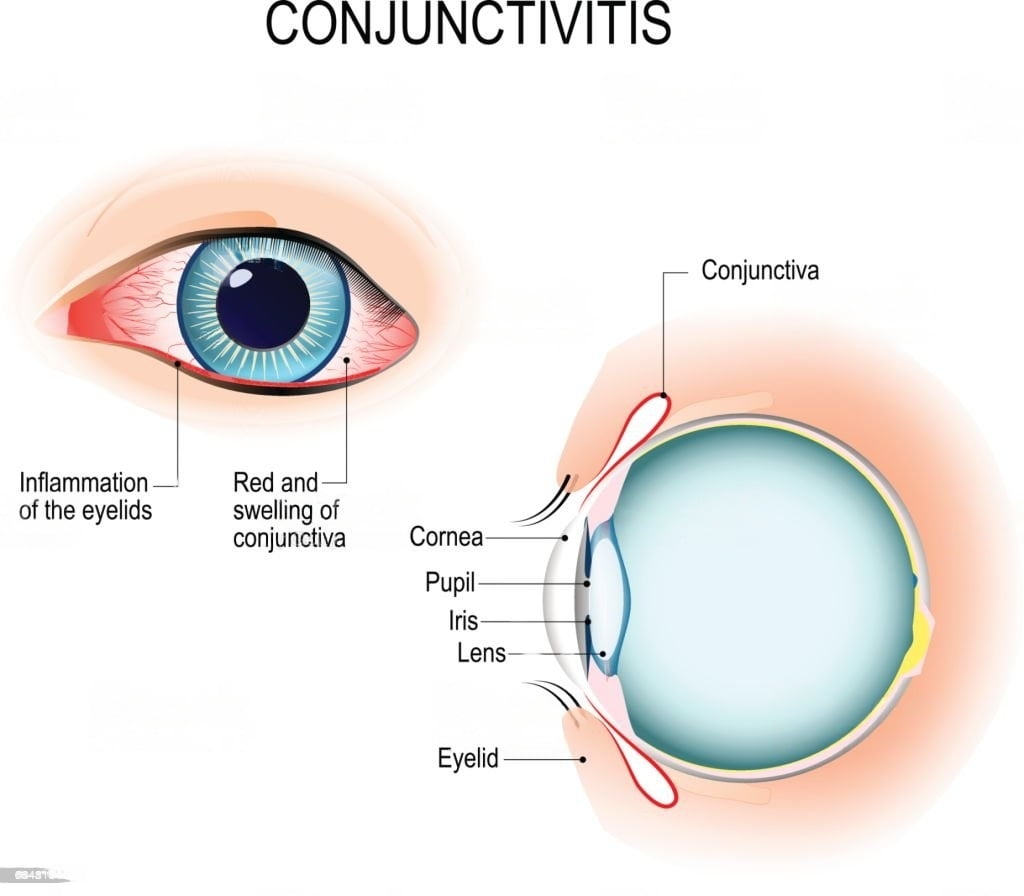 Eye flu treatment at home : Symptoms, Cause and 5 easy tips.
