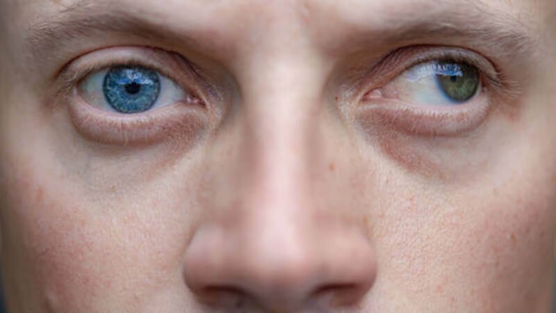 Lazy eye (Amblyopia) - EYE X SOLUTIONS ENTERPRISE